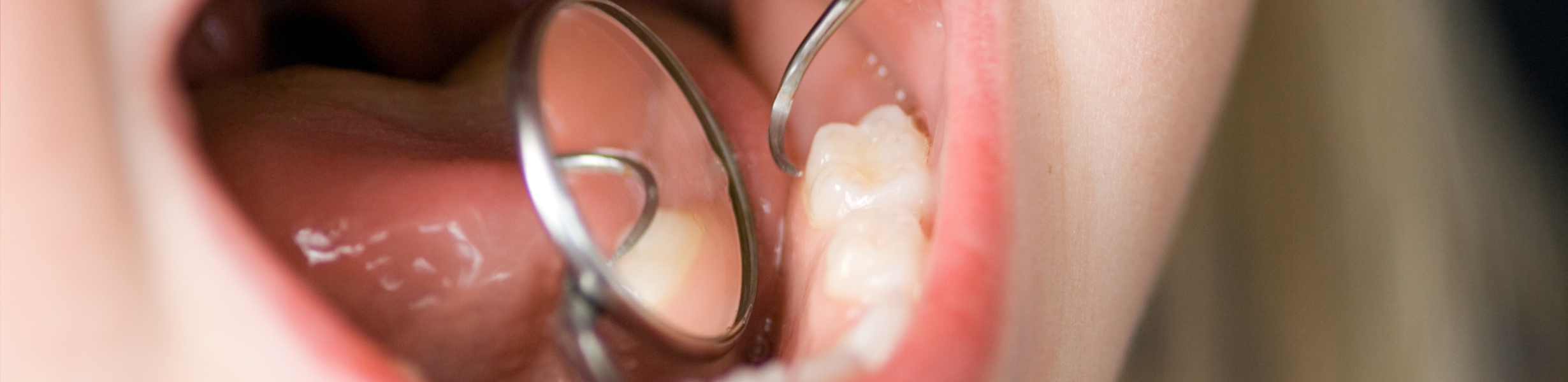 Tooth Filling | Dental Fillings | The Tooth Company